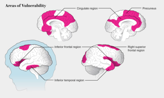 Poverty and the Brain